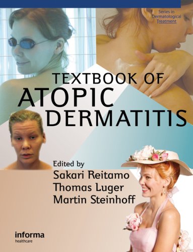 Download Textbook of Atopic Dermatitis book - Dragos