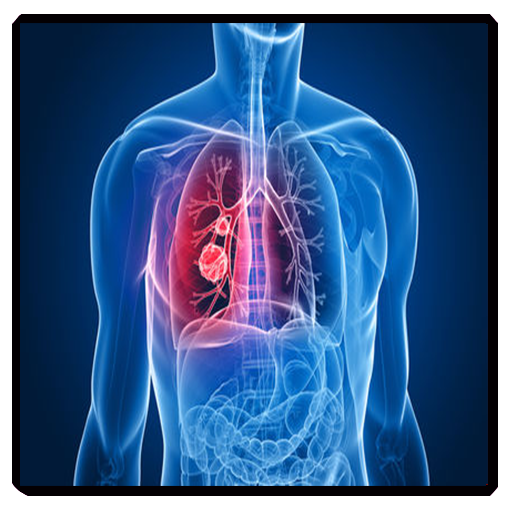 Die akute Bronchitis – keine harmlose Erkältungskrankheit